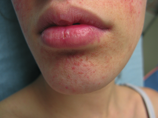 Comprendre la maladie STB