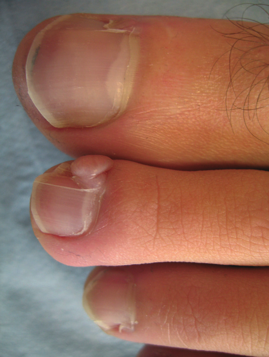 Comprendre la maladie STB